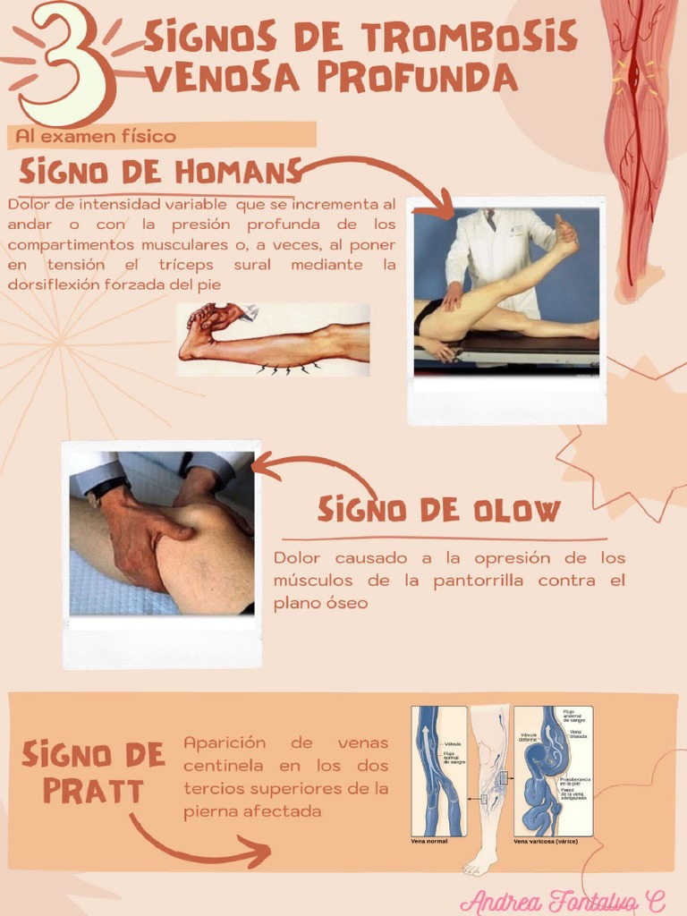 3 Signos de Trombosis Venosa Profunda | PDF