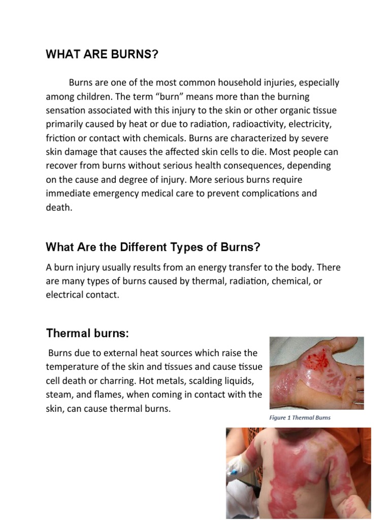 BURNS | PDF | Burn | Injury