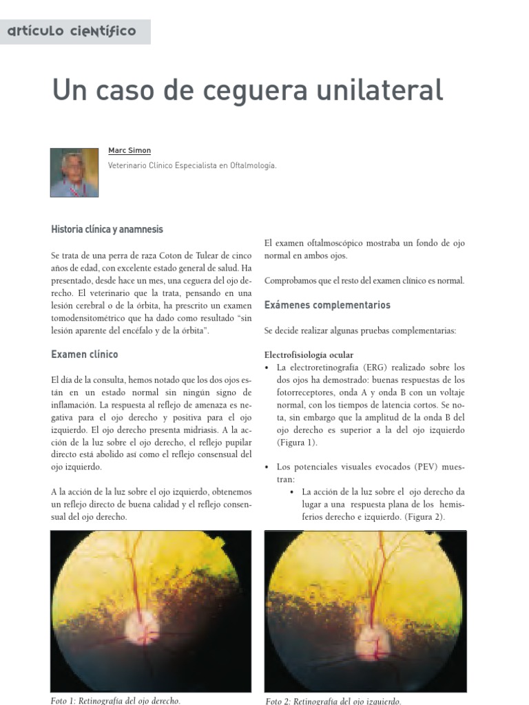 3 Ceguera Unilateral | PDF | Diabetes mellitus | Insulina