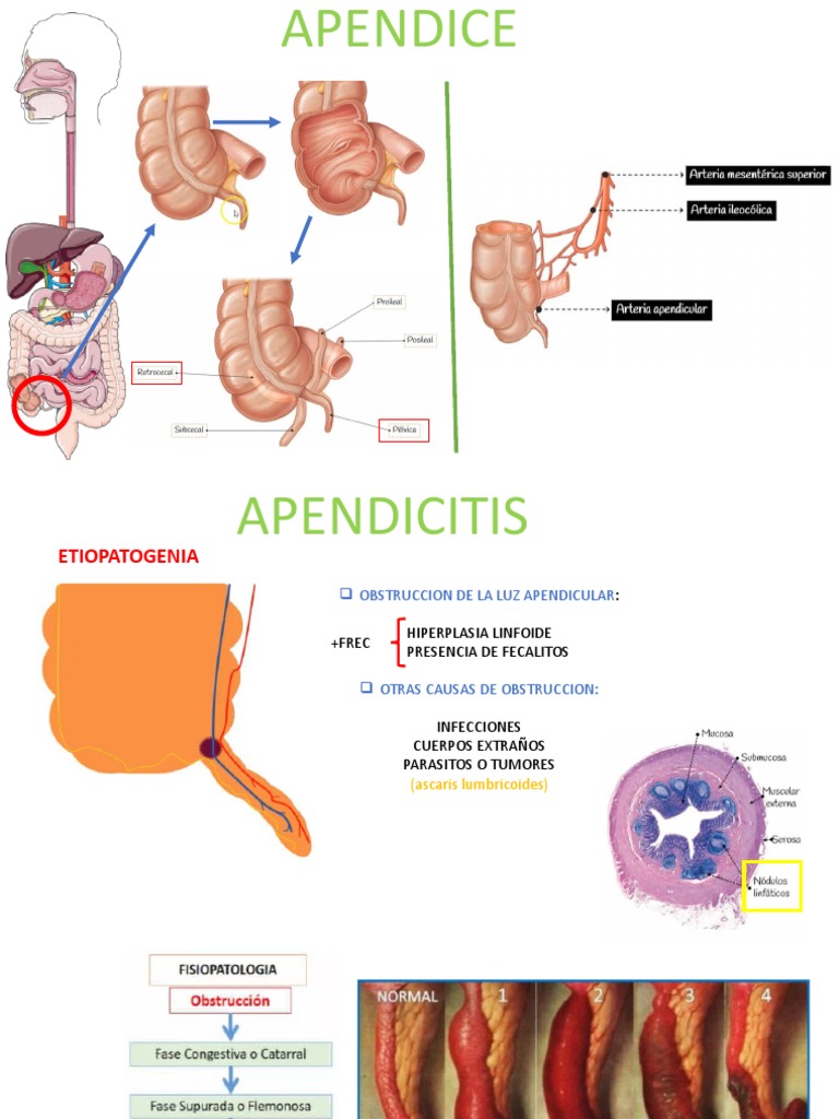 Apendicitis Aguda | PDF | Enfermedades y trastornos | Emergencias Médicas