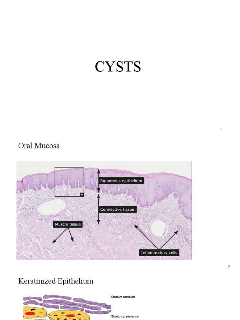 Classification and Characteristics of Cysts in the Oral Cavity | PDF ...