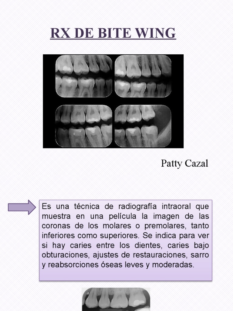 Radiografía bite wing: descripción de la técnica y sus indicaciones | PDF