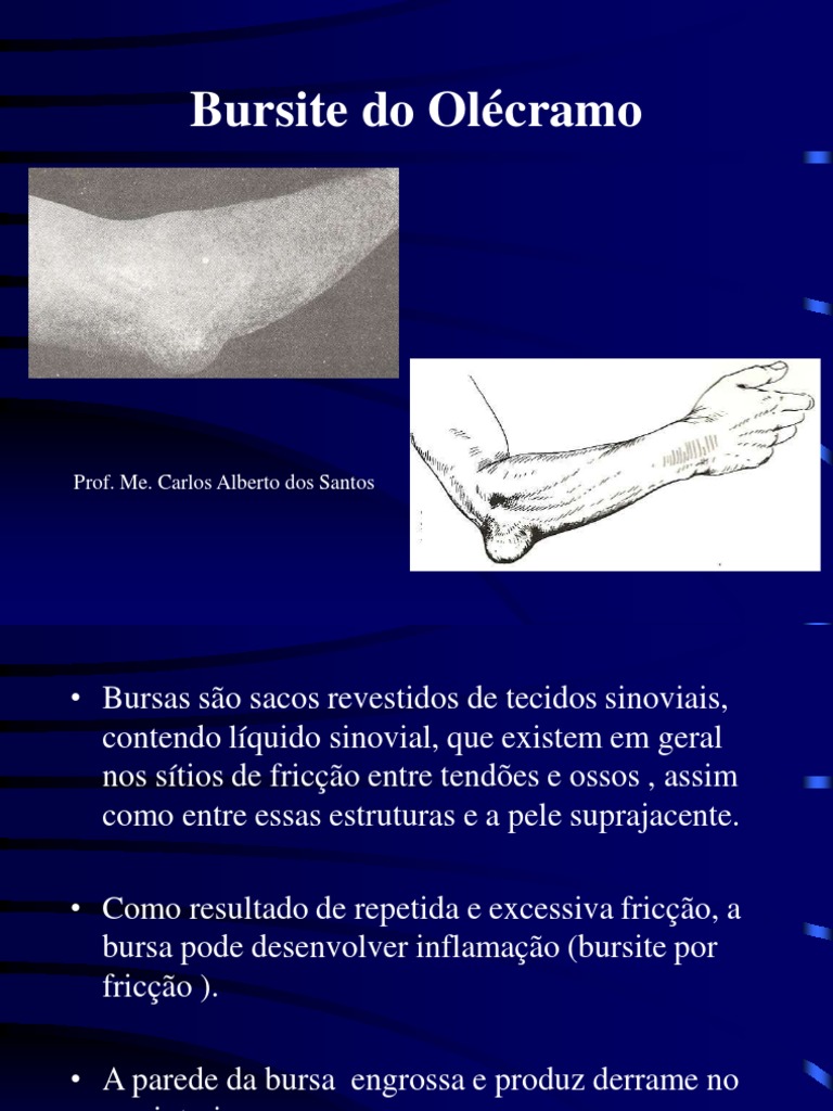 Bursite do Olécrano(1) | PDF
