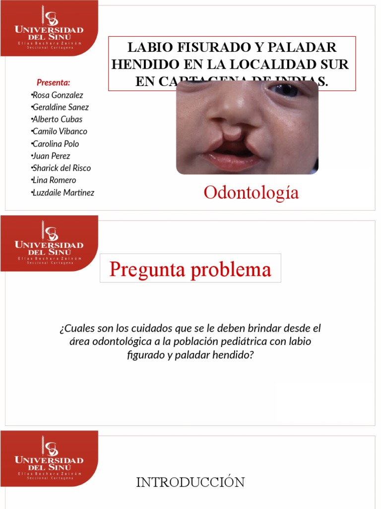 Labio Fisurado Y Paladar Hendido en La Localidad Sur en Cartagena de ...