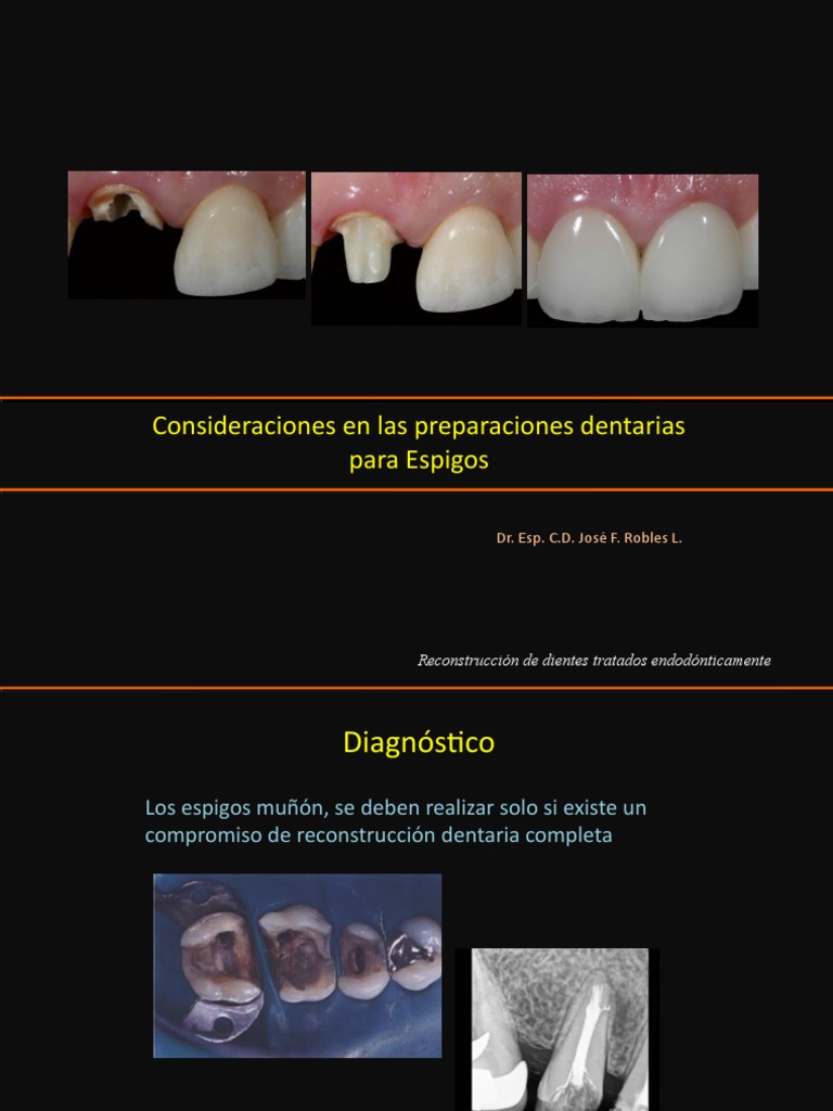 Preparación y Tipos de Espigos Dentales | PDF | Dentadura postiza ...