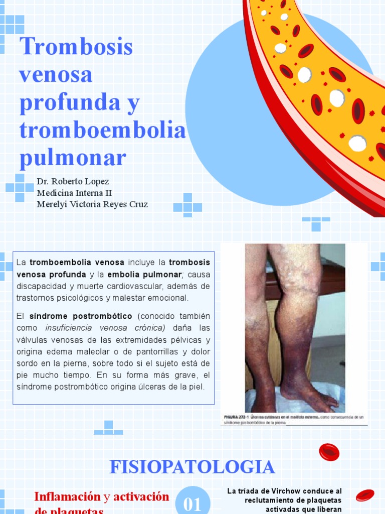 Trombosis Venosa Profunda y Tromboembolia Pulmonar: Dr. Roberto Lopez ...