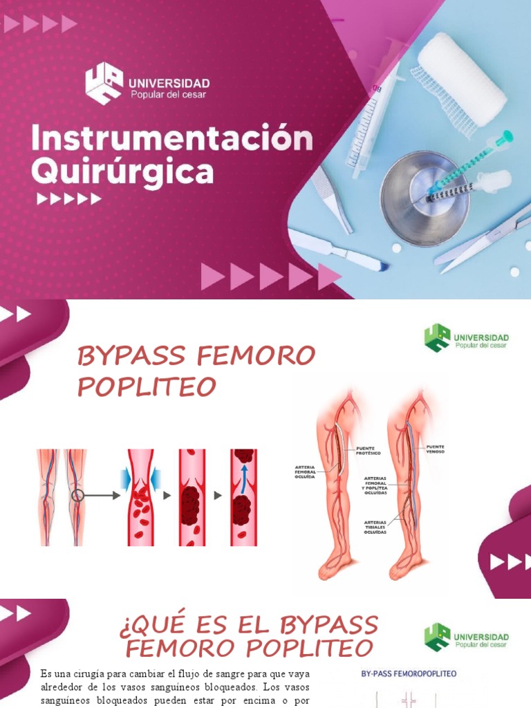 Bypass Femoro-Popliteo | PDF | Cirugía de bypass de la arteria coronaria | Especialidades Medicas
