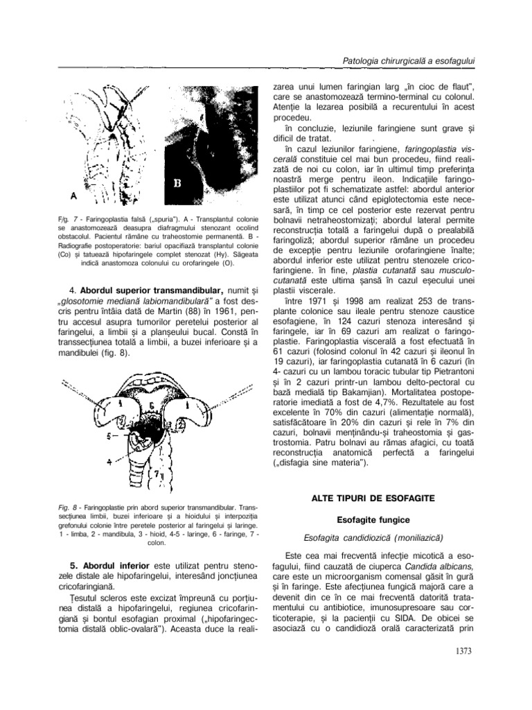 Esofagita Caustica | PDF