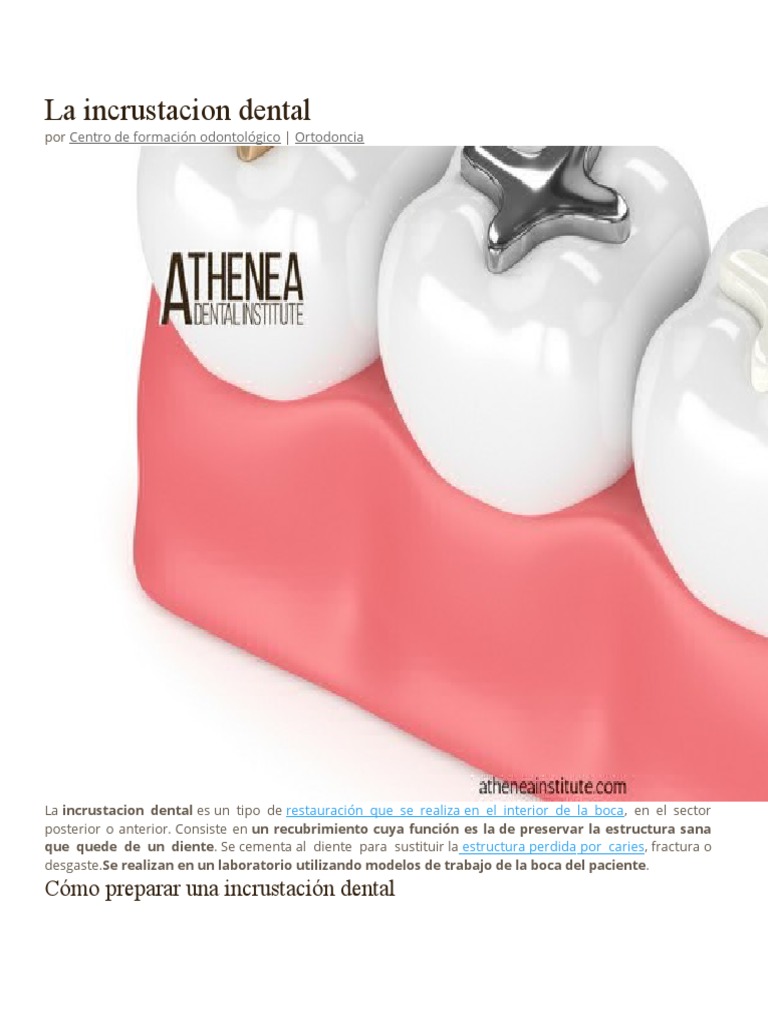 Tipos y Proceso de Incrustaciones Dentales | PDF | Compuesto Dental ...