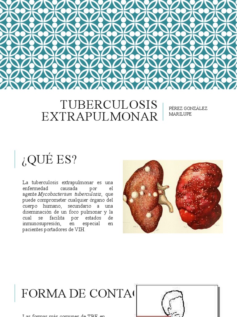 Tuberculosis extrapulmonar | PDF