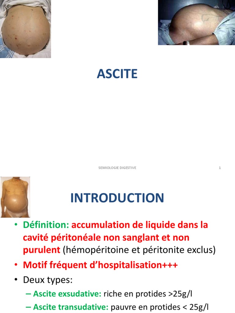 4 - Ascite | PDF