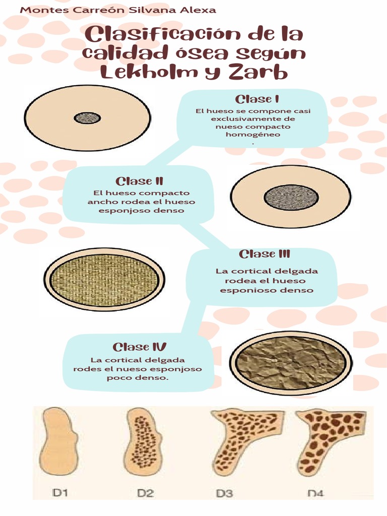 Clasificación de La Calidad Ósea Según Lekholm y Zarb | PDF