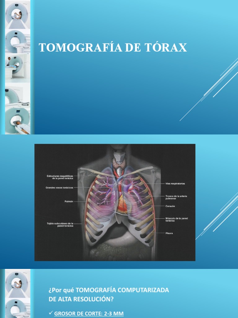 Tomografía Computarizada de Tórax | PDF