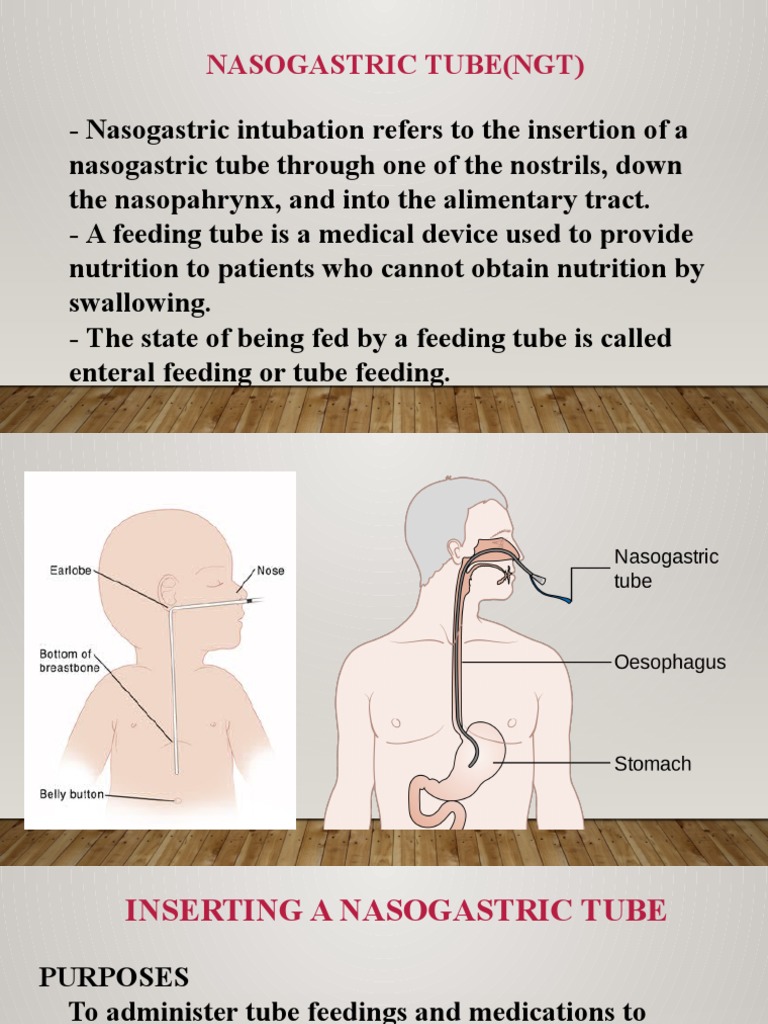 Nasogastric Tube Guide for Patients | PDF
