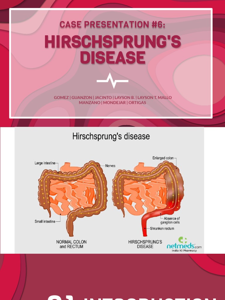 Case Presentation 6 Hirschsprungs Disease 1 PDF | PDF