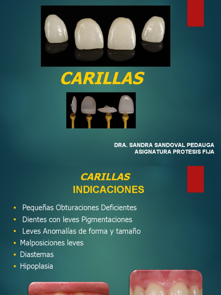 Carillas Inlays y Overlays | PDF