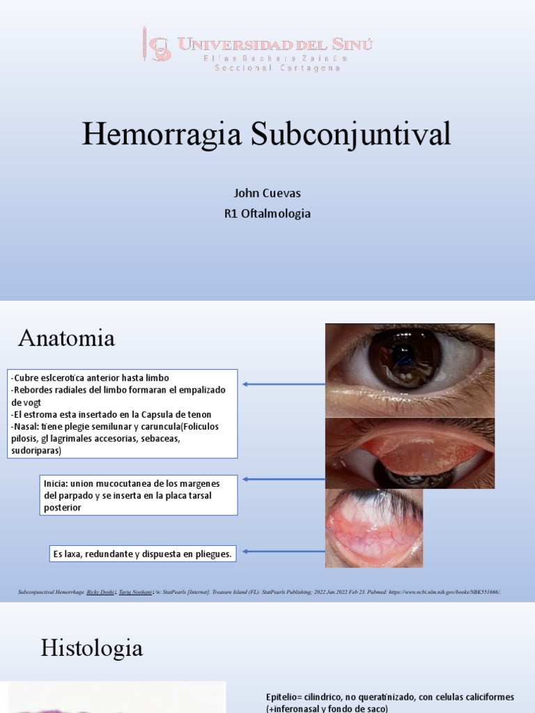 Hemorragia Subconjuntival: John Cuevas R1 Oftalmologia | PDF ...