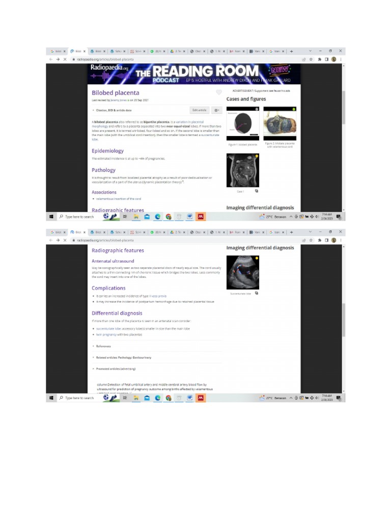 Bilobed Placenta Imaging | PDF