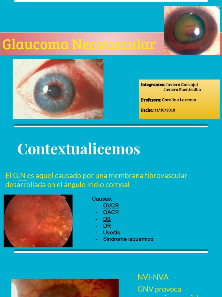 glaucoma neovascular | PDF | Glaucoma | Sistema visual