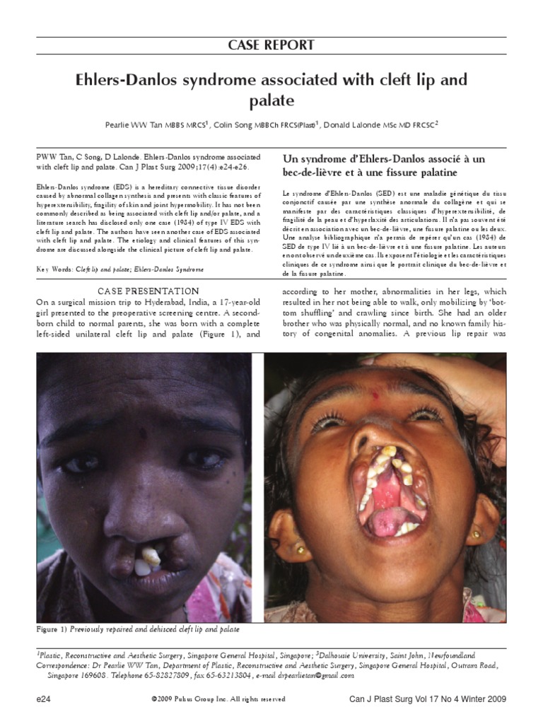 Ehlers Danlos Syndrome Associated With Cleft Lip and Palate | PDF | Clinical Medicine | Diseases ...