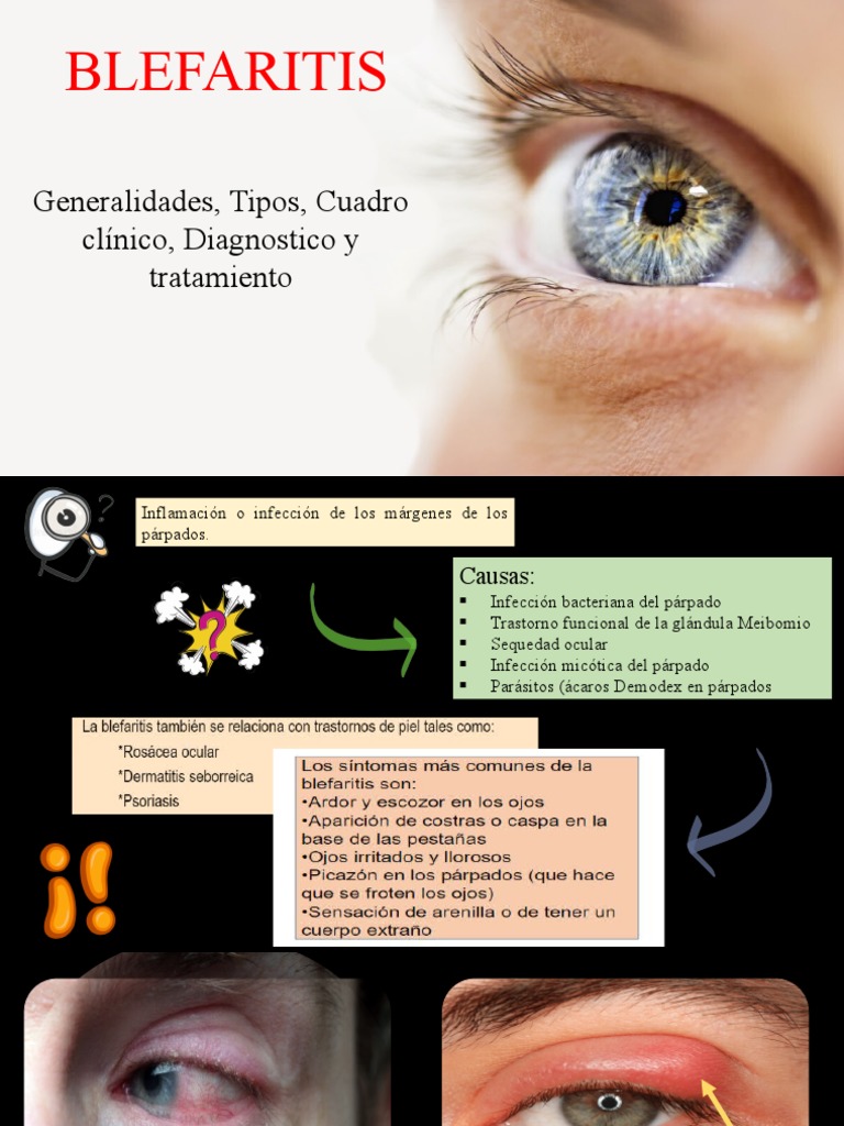 Blefaritis: Generalidades, Tipos, Cuadro Clínico, Diagnostico y Tratamiento | PDF ...