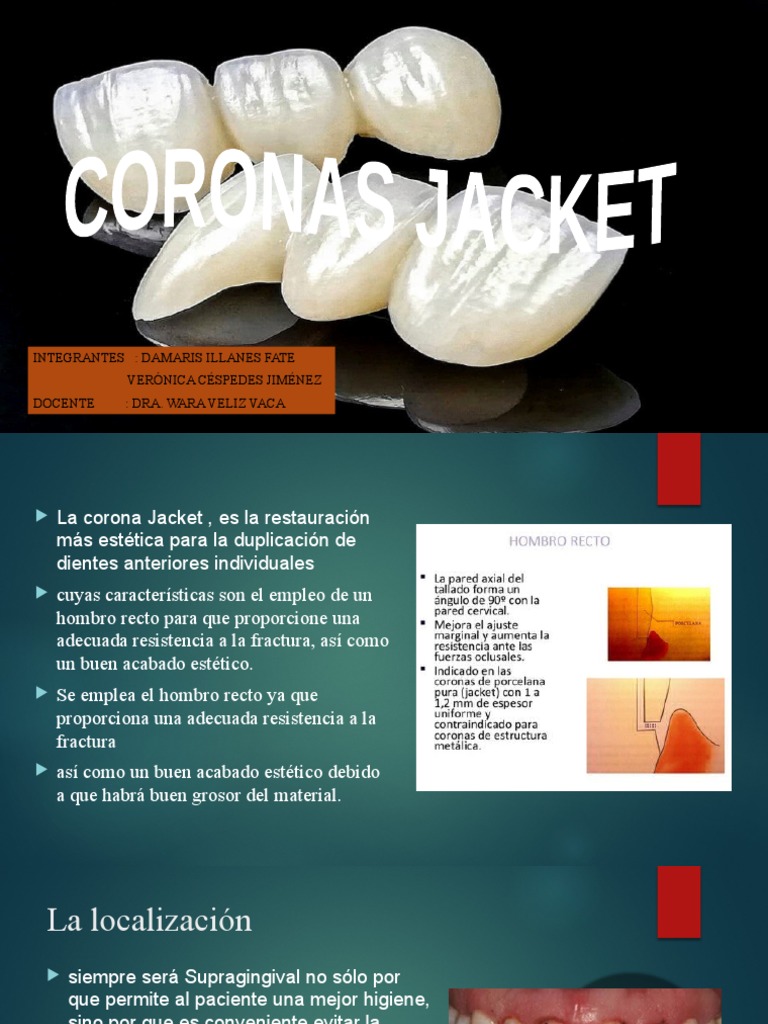 Corona Jacket: Estética y Técnica Dental | PDF | Hogar, jardinería y ...