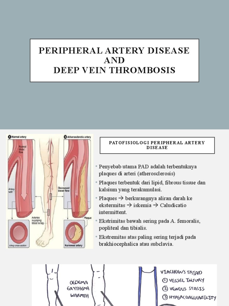 PR PAD Daan DVT | PDF