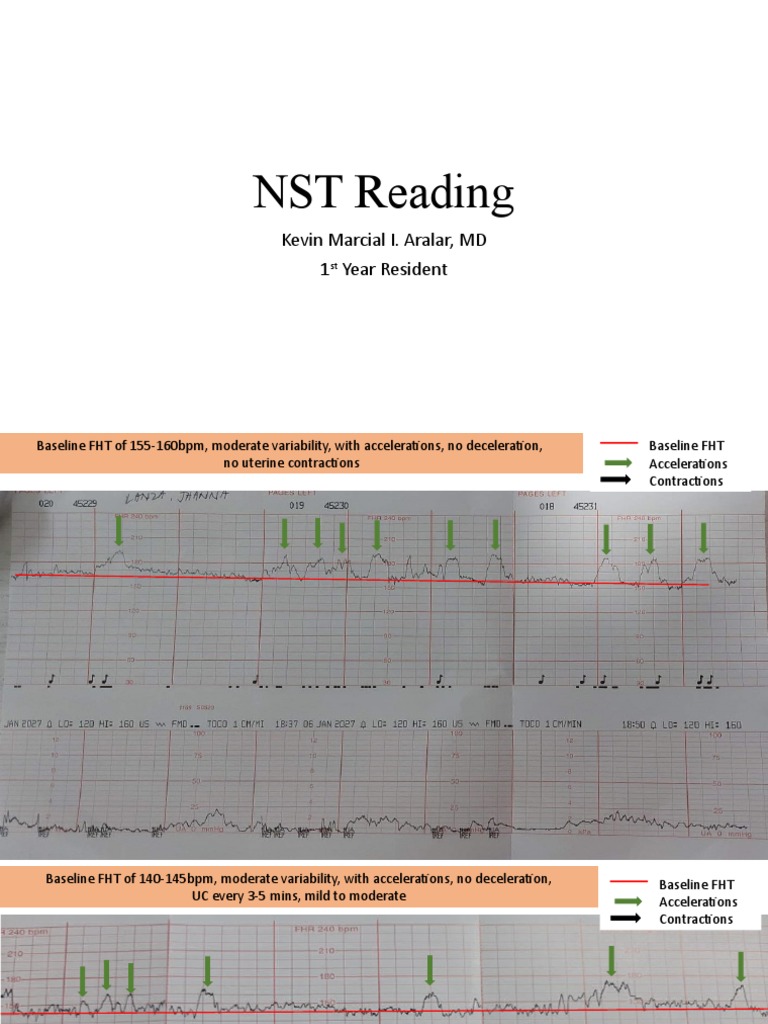 NST Reading: Kevin Marcial I. Aralar, MD 1 Year Resident | PDF ...