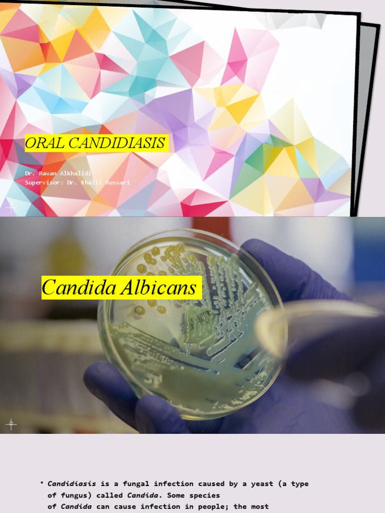 Oral Candidiasis | PDF | Candidiasis | Immunology