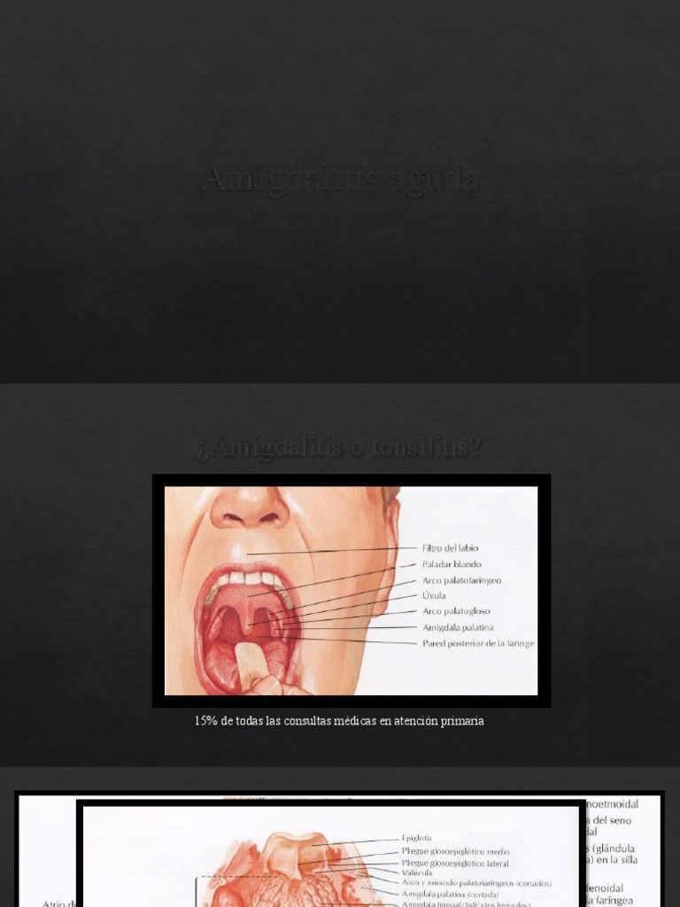 Amigdalitis Aguda: Diagnóstico y Tratamiento | PDF | Ciencias de la Salud | Medicina