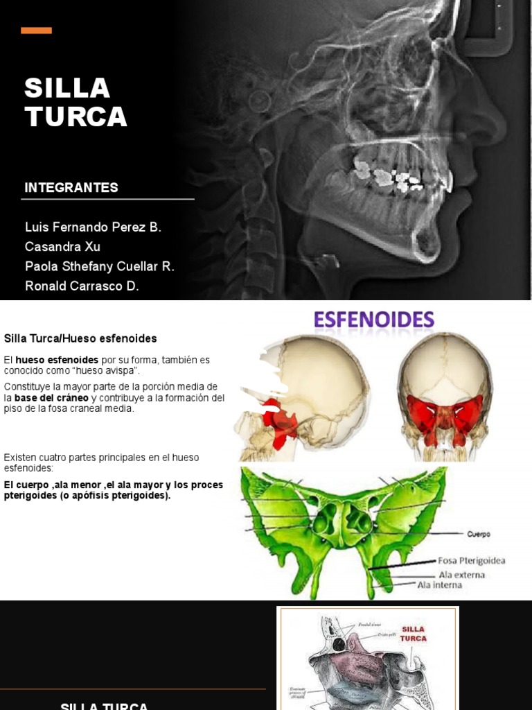 Anatomía De La Silla Turca Cirugía Transesfenoidal | Cirujano