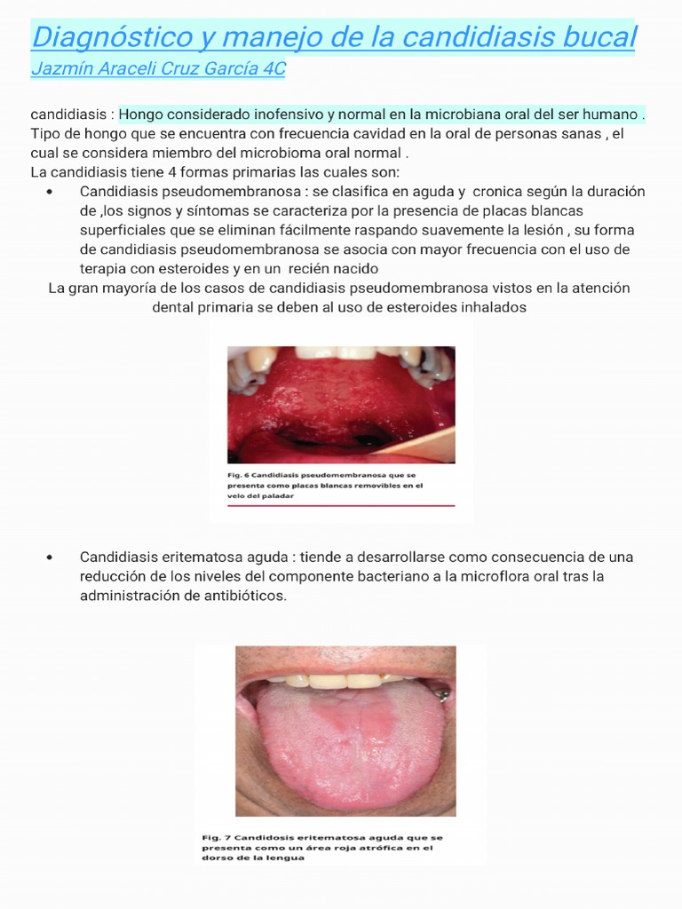 Candidiasis Oral Resumen | PDF
