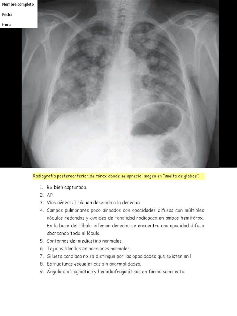 Radiografía de Tórax | PDF