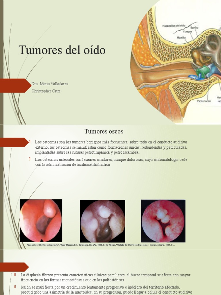 Tumores Del Oído: Dra. Maria Valladares Christopher Cruz | PDF ...