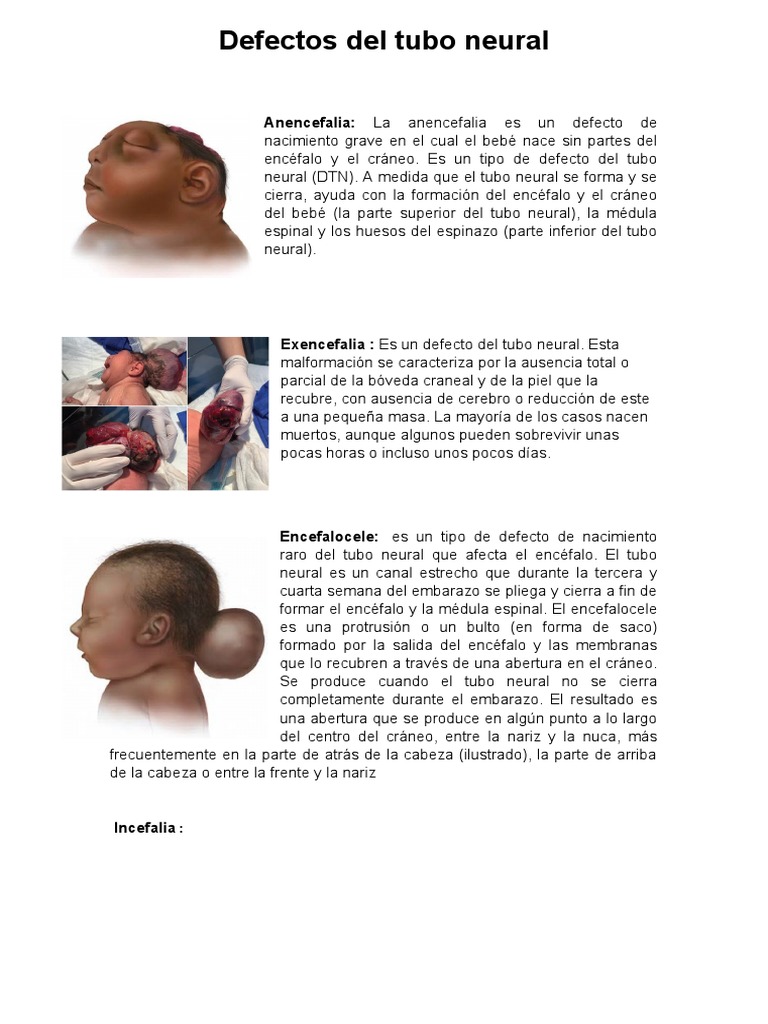 Defectos Del Tubo Neural | PDF | Enfermedades y trastornos ...