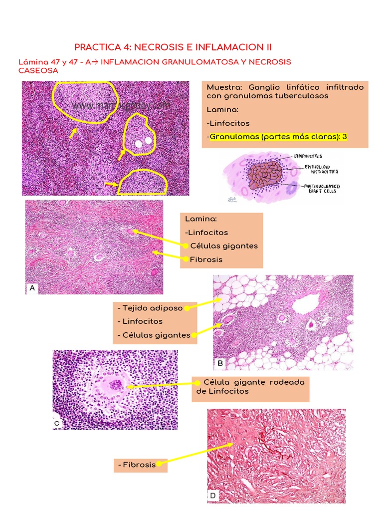 Practica 4: Necrosis E Inflamacion Ii: Lámina 47 Y 47 - A Inflamacion ...