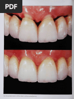 Design Sequence Partial Dentures F Sutton - Compressed | PDF