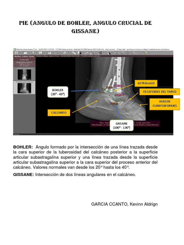Pie (Angulo de Bohler, Angulo Crucial de Gissane) : BOHLER: Angulo ...