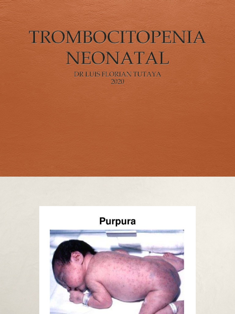 13 Trombocitopenia Neonatal | PDF | Parto prematuro | Plaqueta