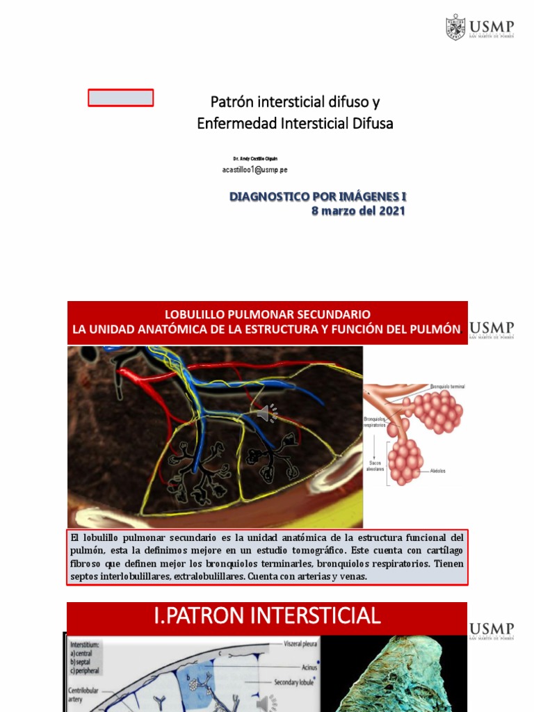 Patrón Intersticial Difuso y Enfermedad Intersticial Difusa ...