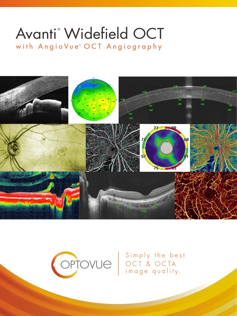 Intl Avanti-AngioVue Brochure PDF | PDF | Retina | Cornea
