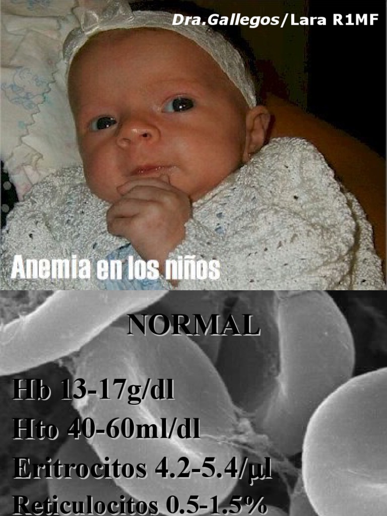 Anemias en Pediatria | PDF | Vitamina B12 | Sangre