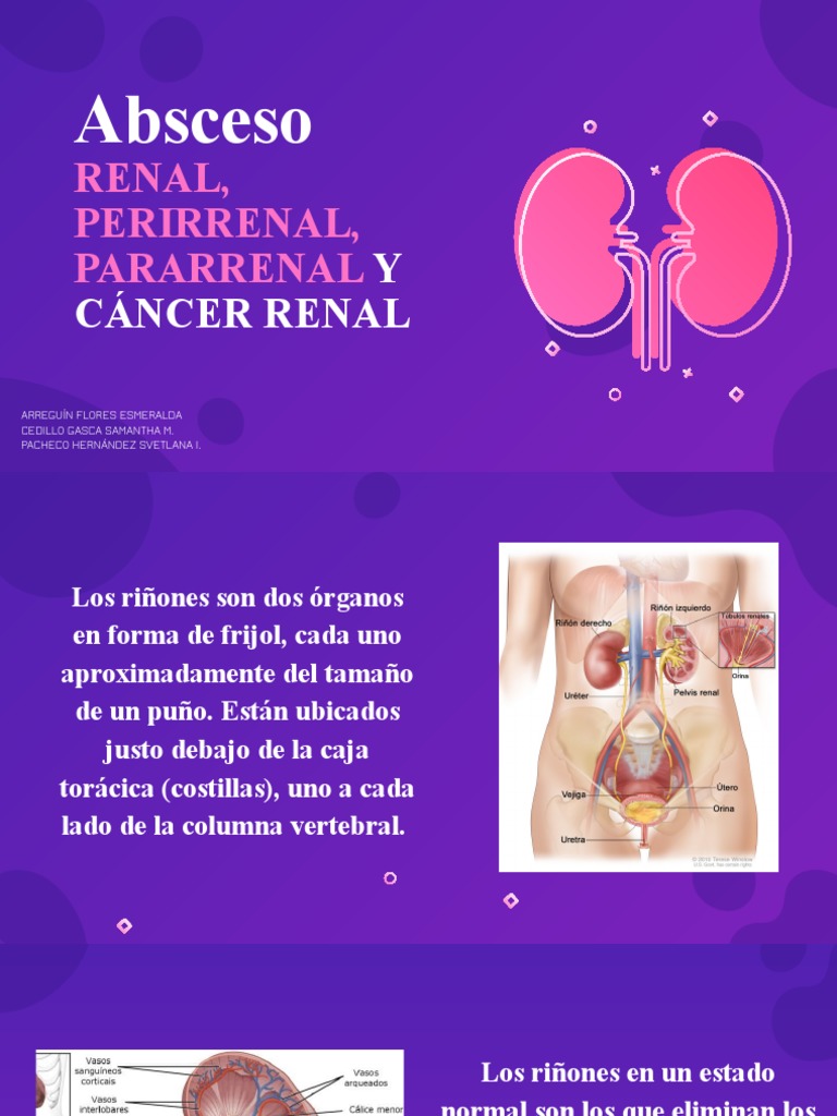 Abscesos y Cáncer renal.pptx | PDF
