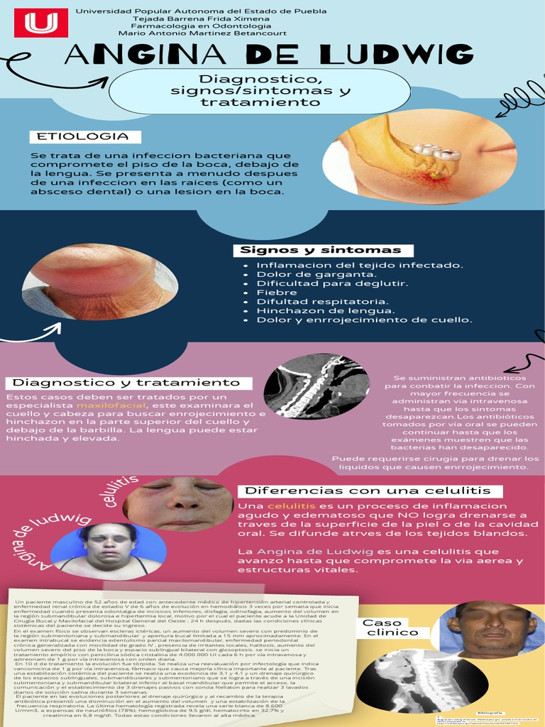 InfografÃ - A ANGINA DE LUDWIG PDF | PDF