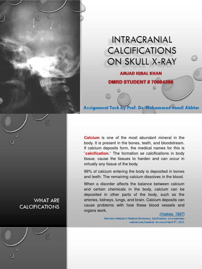 Aik 70084398 - Intracranial Calcifications On Skull X-Ray PDF | PDF