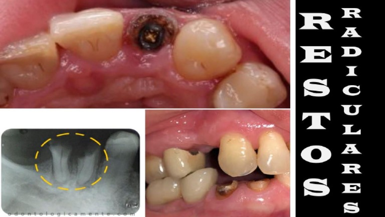 Restos Radiculares | PDF