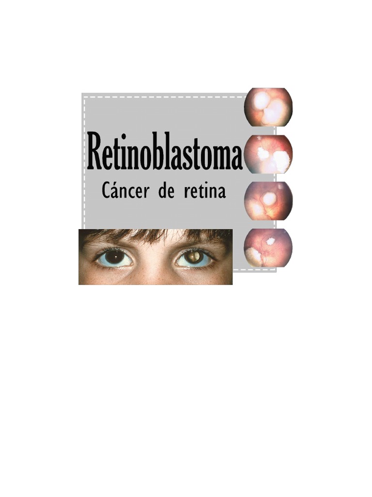 Retinoblastoma PDF | PDF