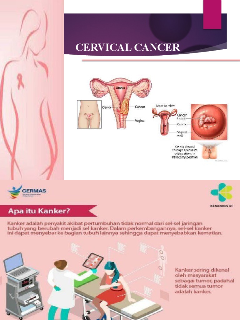 Pencegahan Kanker Serviks | PDF | Pengembangan Diri | Kesehatan Holistik