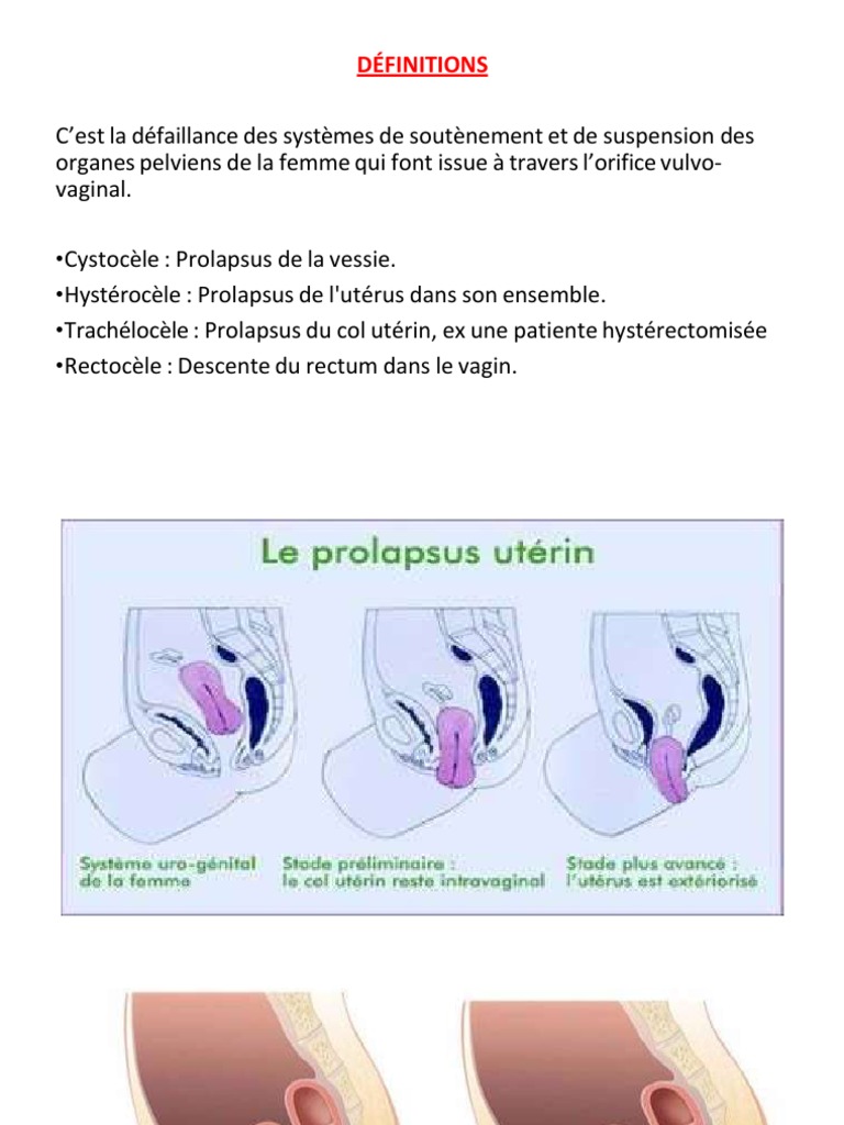 Prolapsus génital : définitions et traitements | PDF