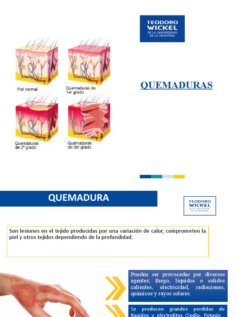 QUEMADURAS | PDF | Quemar | Primeros auxilios